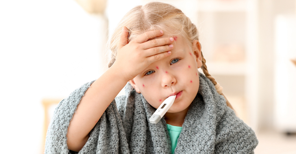 What are the Similarities Between the Chickenpox and Shingles Virus?