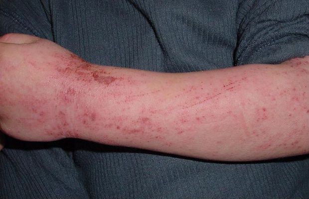What are the Different Types of Eczema?